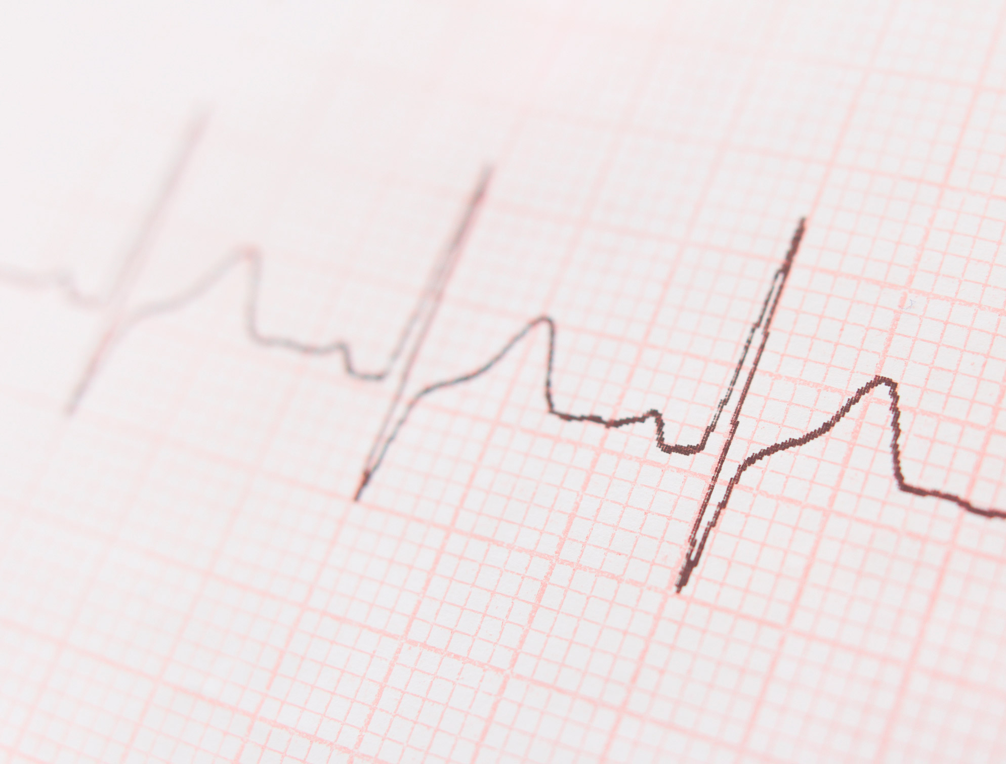 ECG Abnormalities Warn of Heart-Related Risks in Older Women | National ...