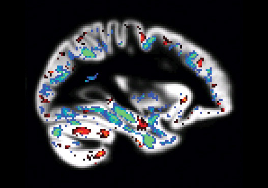 Computers Detect Alzheimer’s Disease in Brain Scans | National ...