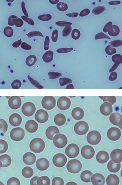 Stem Cell Transplant Reverses Sickle Cell Disease in Adults | National ...